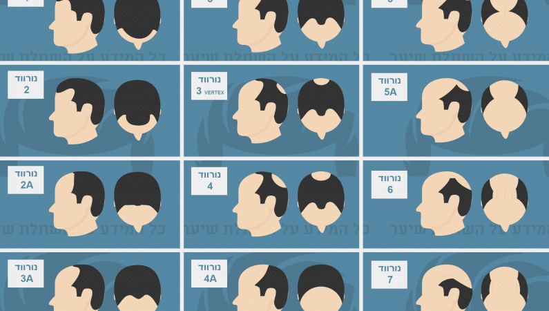 סולם נורווד | נשירת שיער והתקרחות - מינוקס ישראל - Minox IL