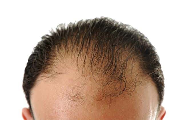 נשירת שיער גברים - מינוקס ישראל - Minox IL